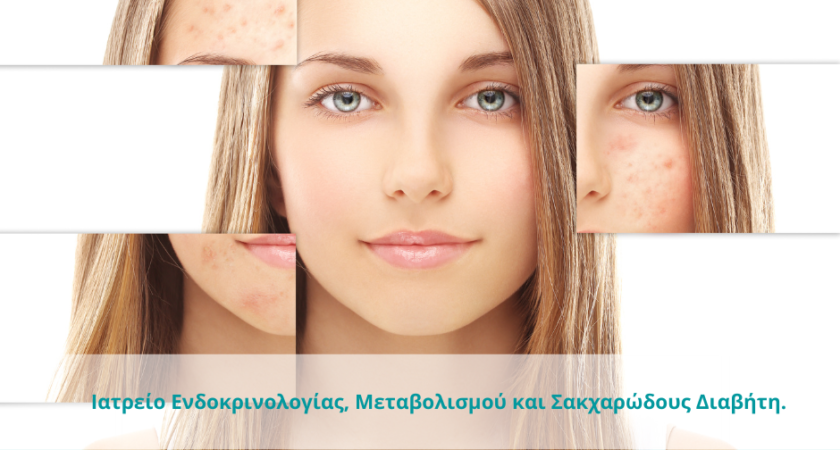 Ορμονικές διαταραχές - Κυπραίος Νικόλαος
